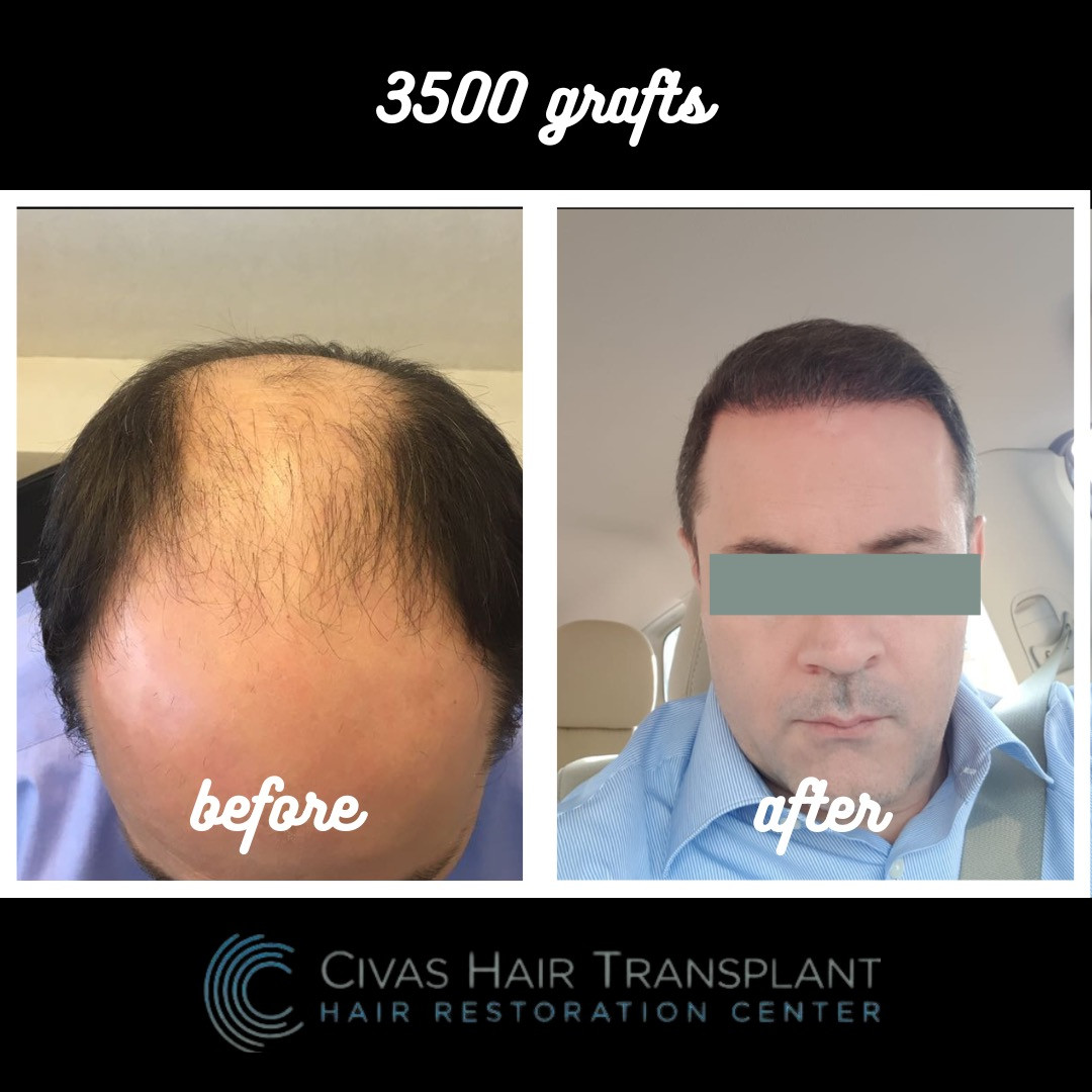 Dr. Ekrem Civas, MD - Before & Afters | IAHRS Member