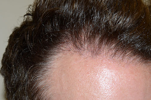 Dr. Jeffrey S. Epstein, M.D., F.A.C.S - Before & Afters | IAHRS Member